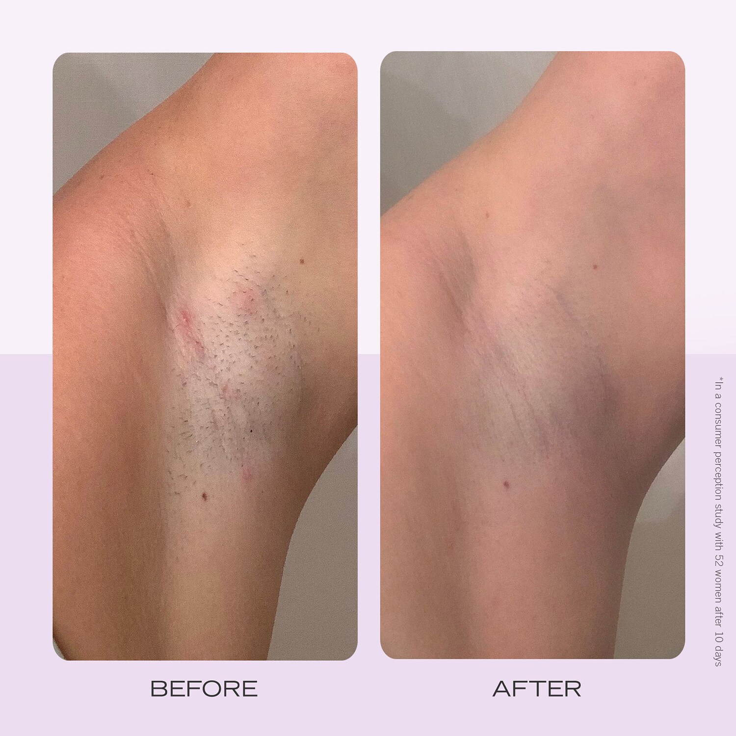 Ingrown Hair Pads - Dischetti compostabili per peli incarniti (60 pz ...